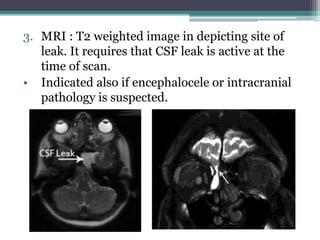 Csf rhinorrhoea | PPTX