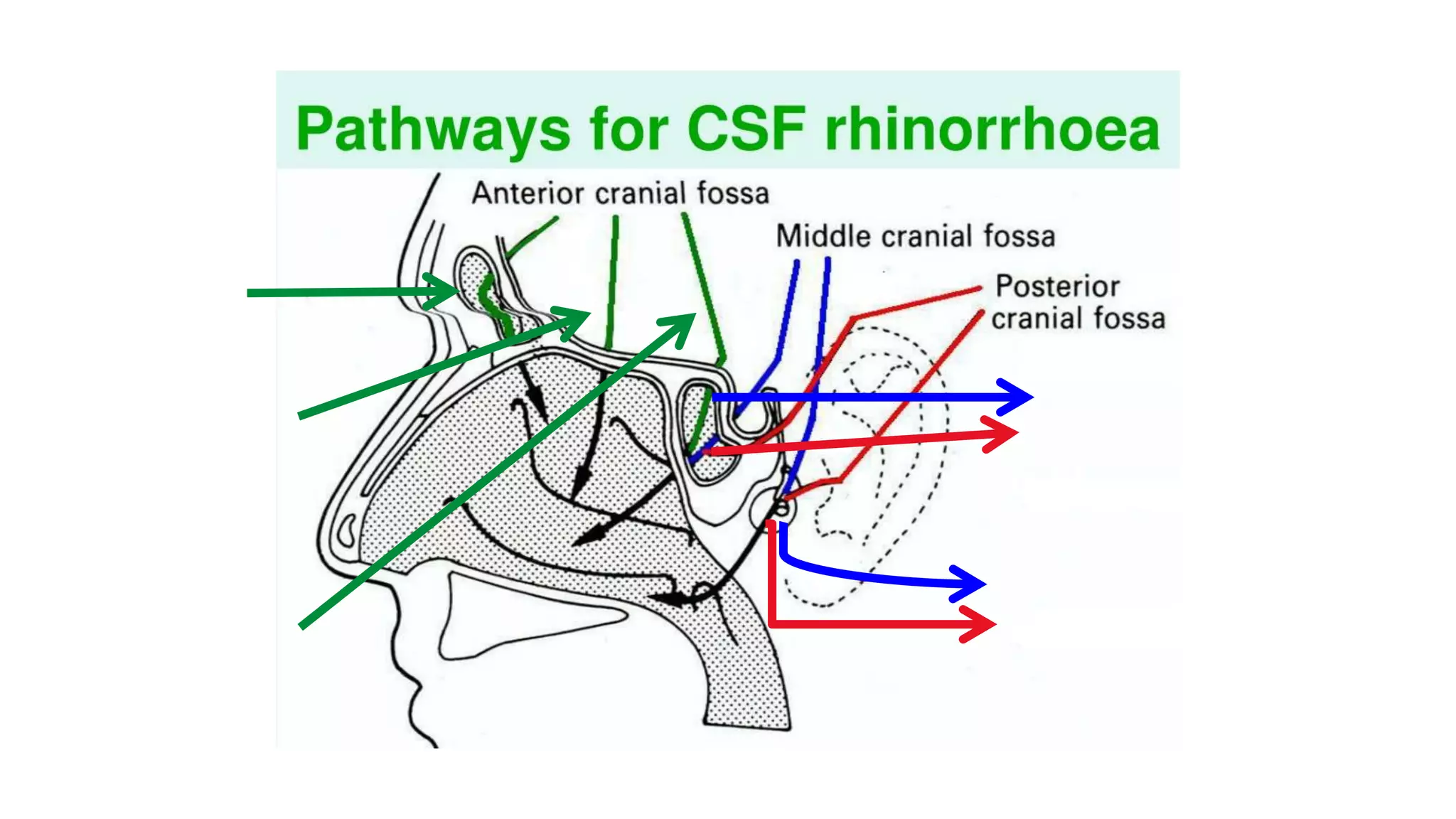 CSF RHINORRHOEA.pptx