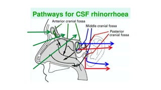 CSF RHINORRHOEA.pptx