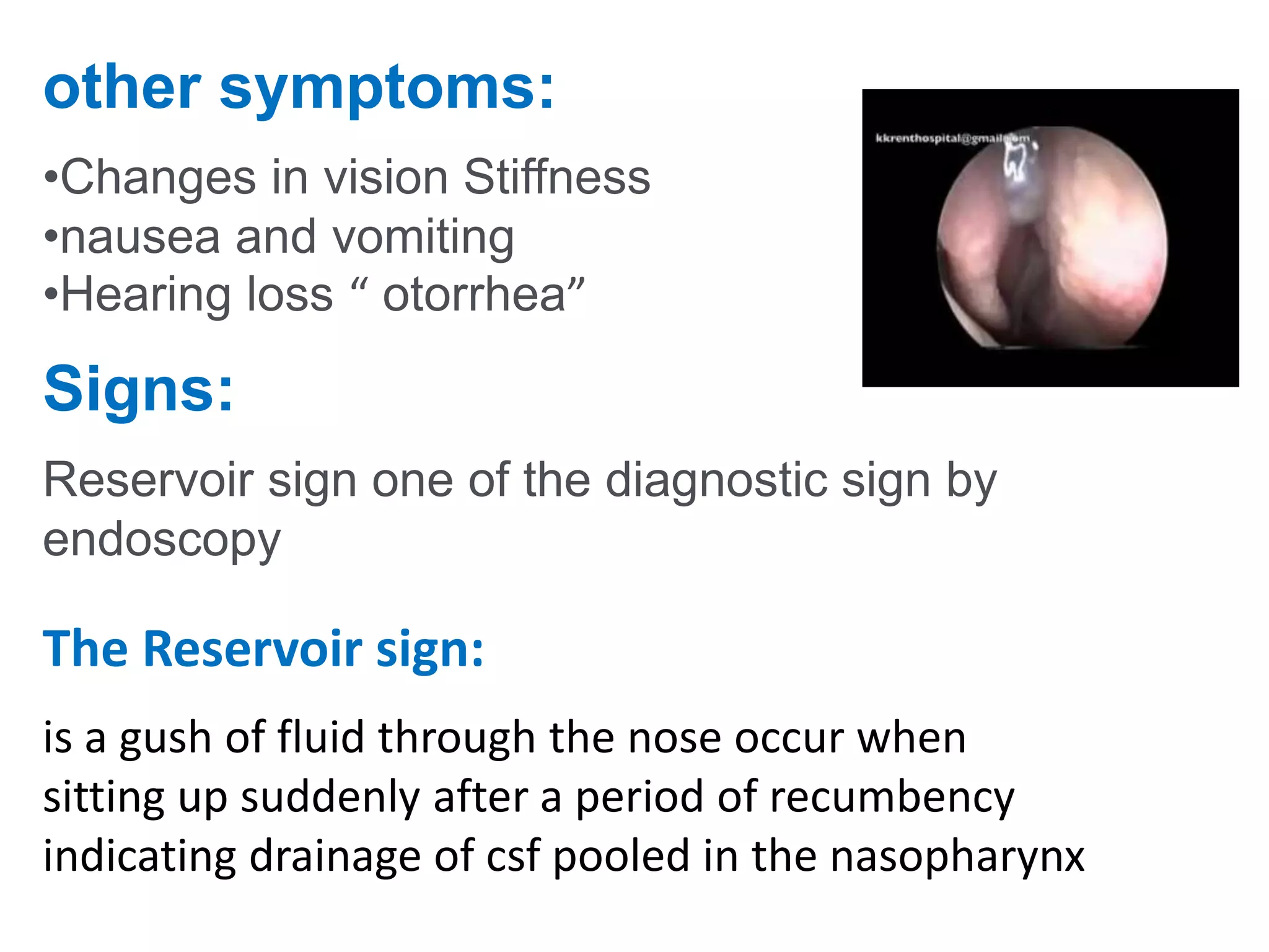 CSF Rhinorrhoea.ppsx