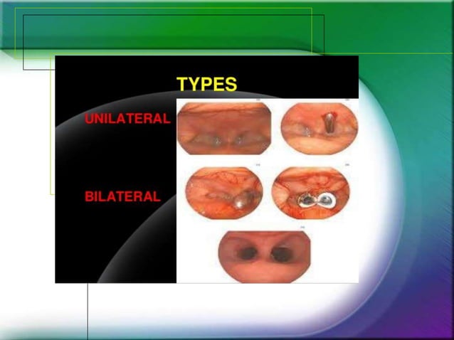 Csf rhinorrhoea, choanal atresia , nasal myiasis | PPTX