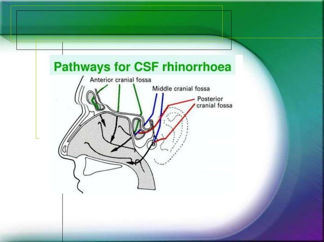 Csf rhinorrhoea, choanal atresia , nasal myiasis | PPTX
