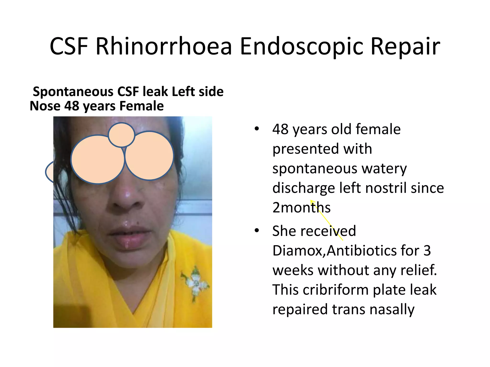 Csf rhinorrhoea endoscopic repair | PPTX