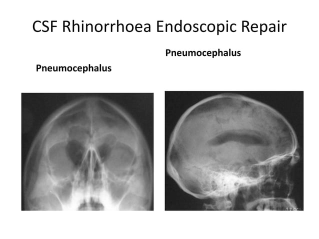 Csf rhinorrhoea endoscopic repair | PPTX