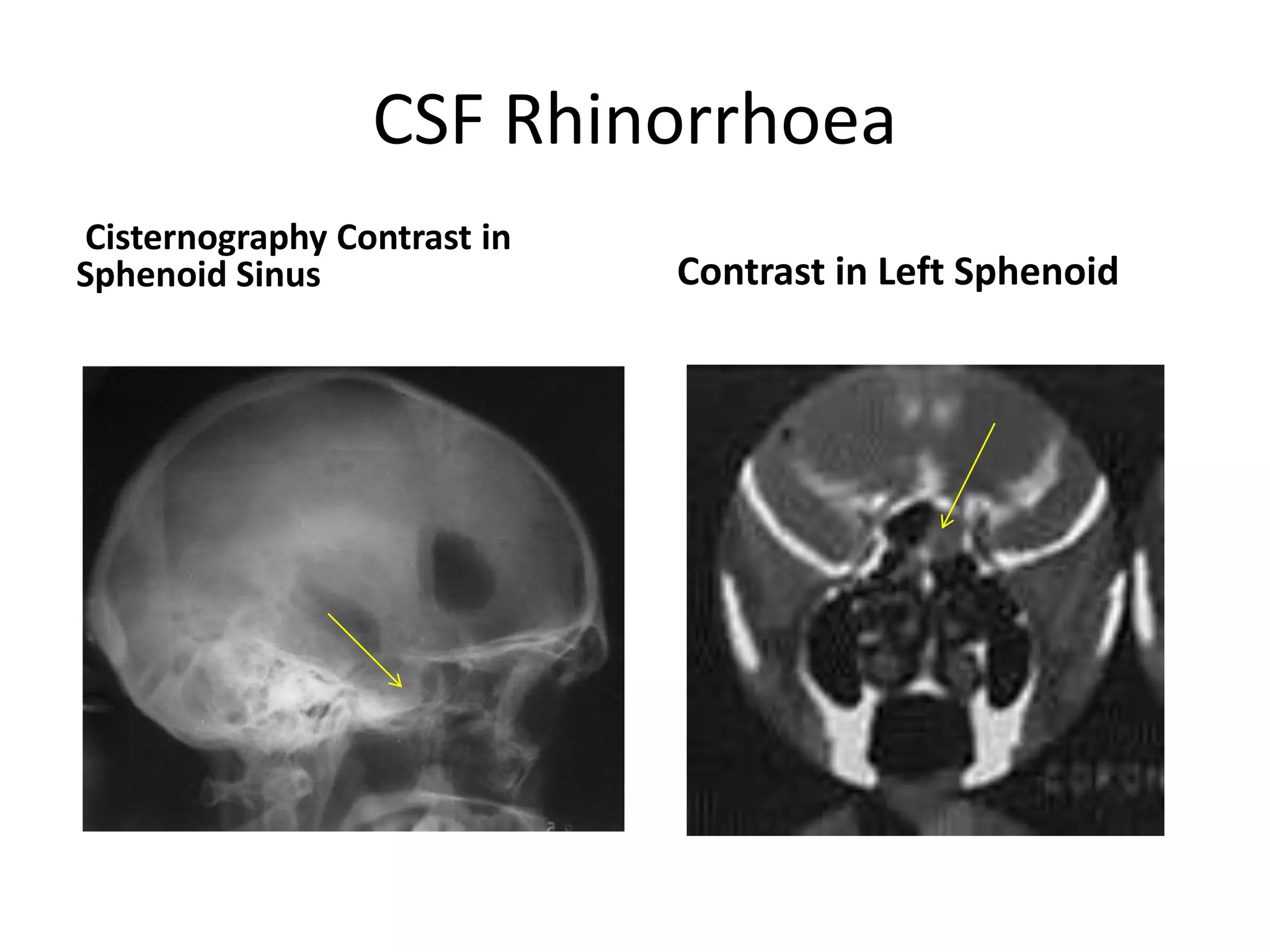 Csf rhinorrhoea endoscopic repair | PPTX