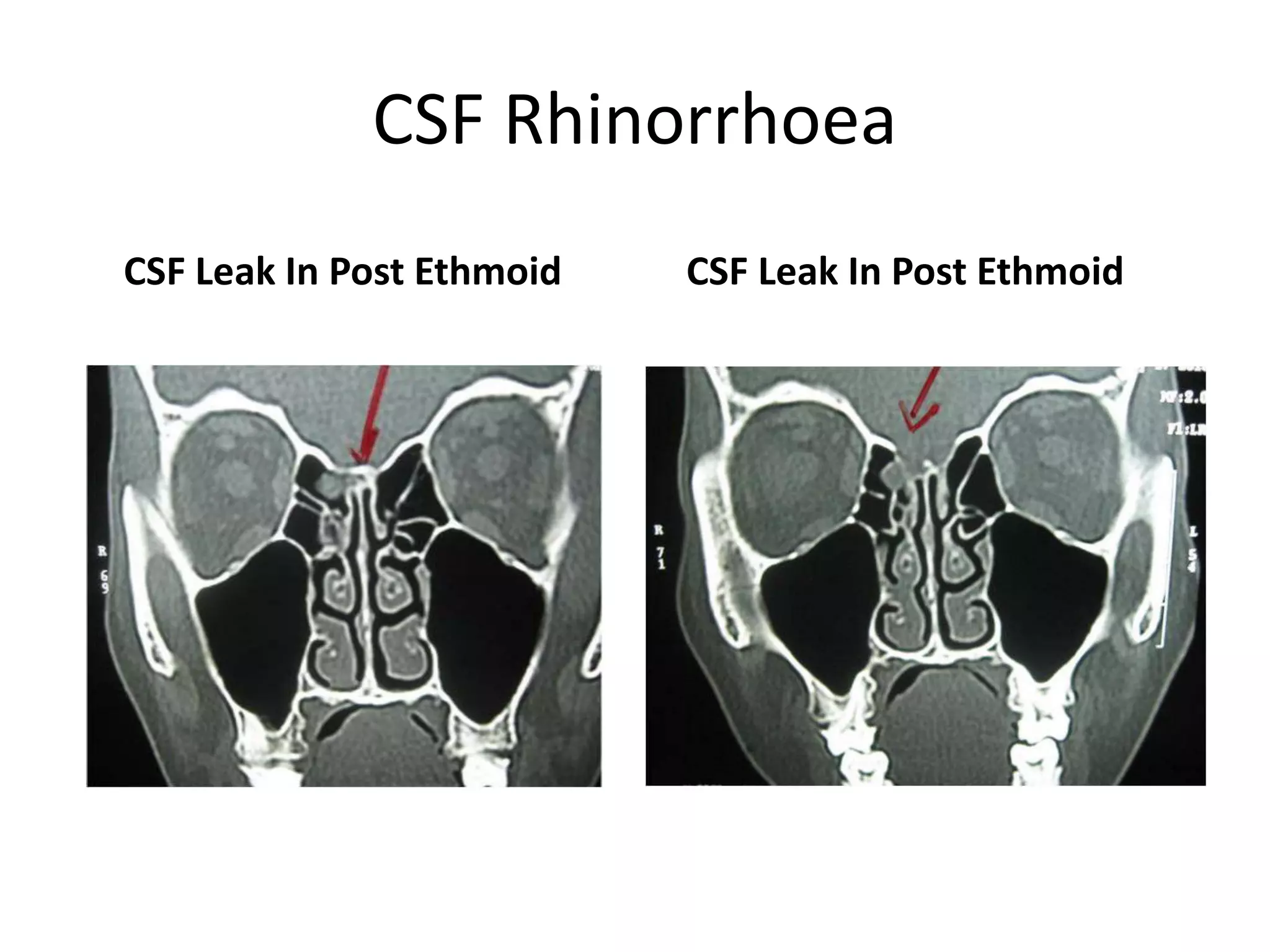 Csf rhinorrhoea endoscopic repair | PPTX