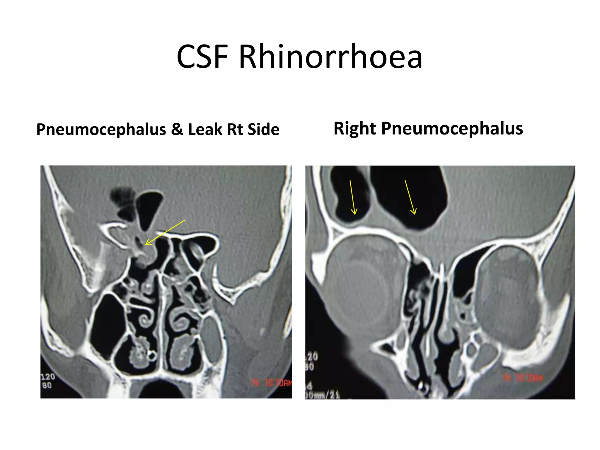 Csf rhinorrhoea endoscopic repair | PPTX