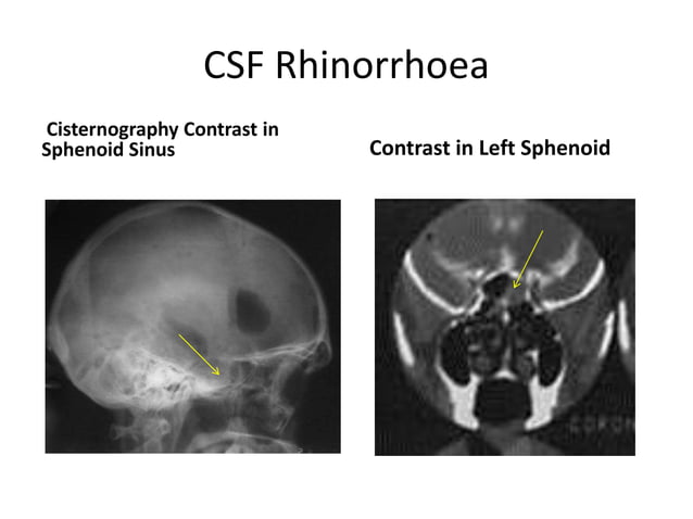 Csf rhinorrhoea endoscopic repair | PPTX | First Aid | Injuries