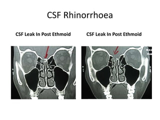 Csf rhinorrhoea endoscopic repair | PPTX