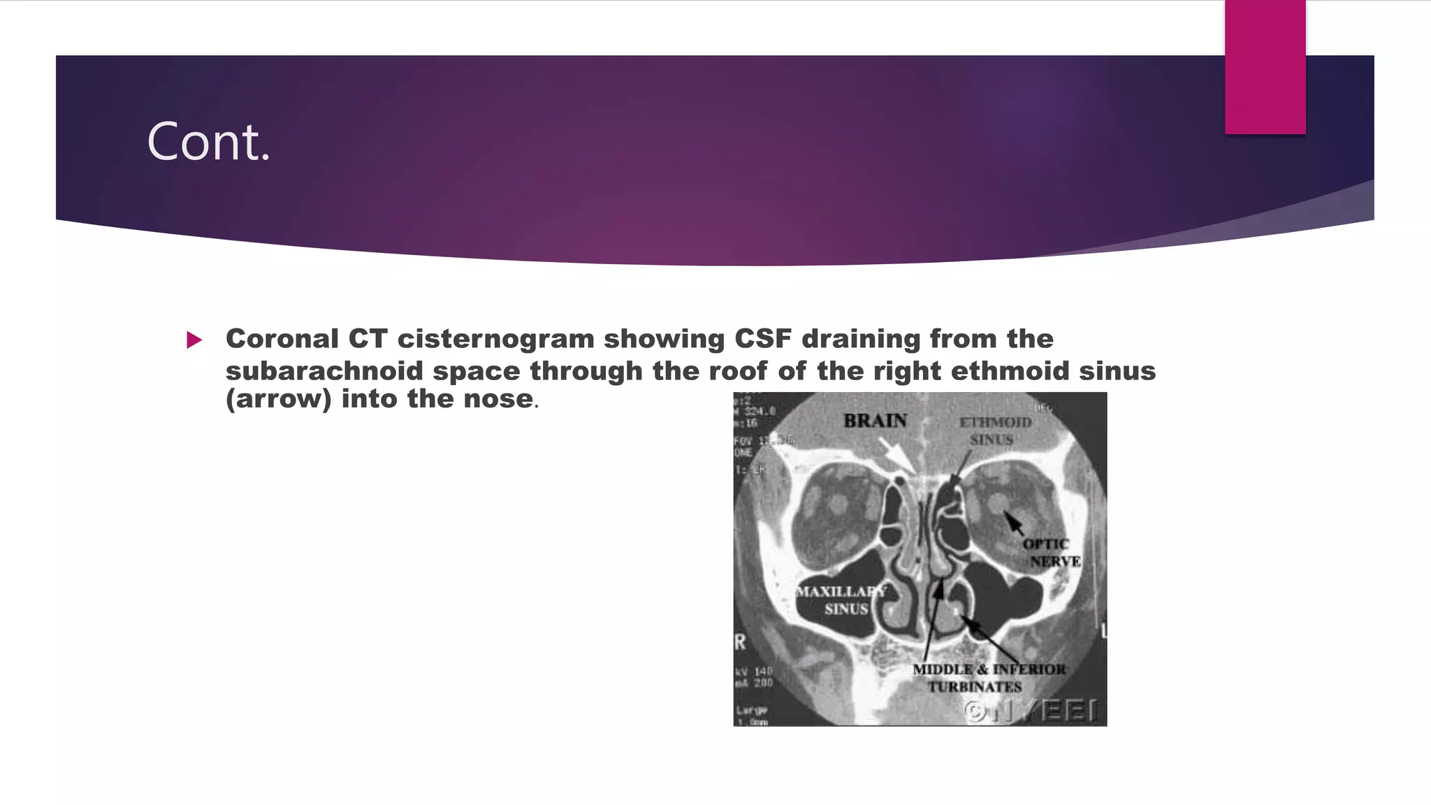 Csf rhinorrhoea | PPTX