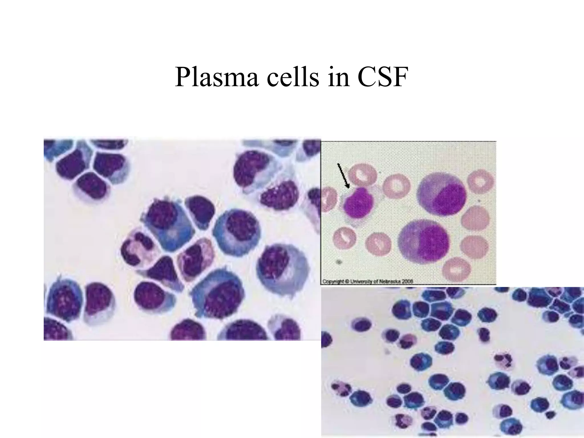 Fluid cytology in CSF