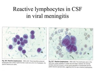 Viral Meningitis Csf