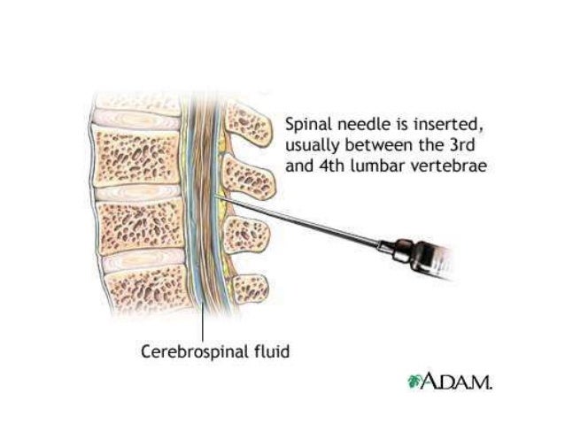Fluid cytology in CSF