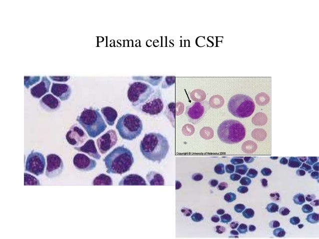 Fluid cytology in CSF