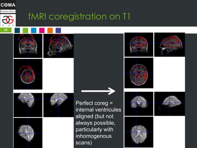 A (quick) introduction to Magnetic Resonance Imagery preprocessing and ...