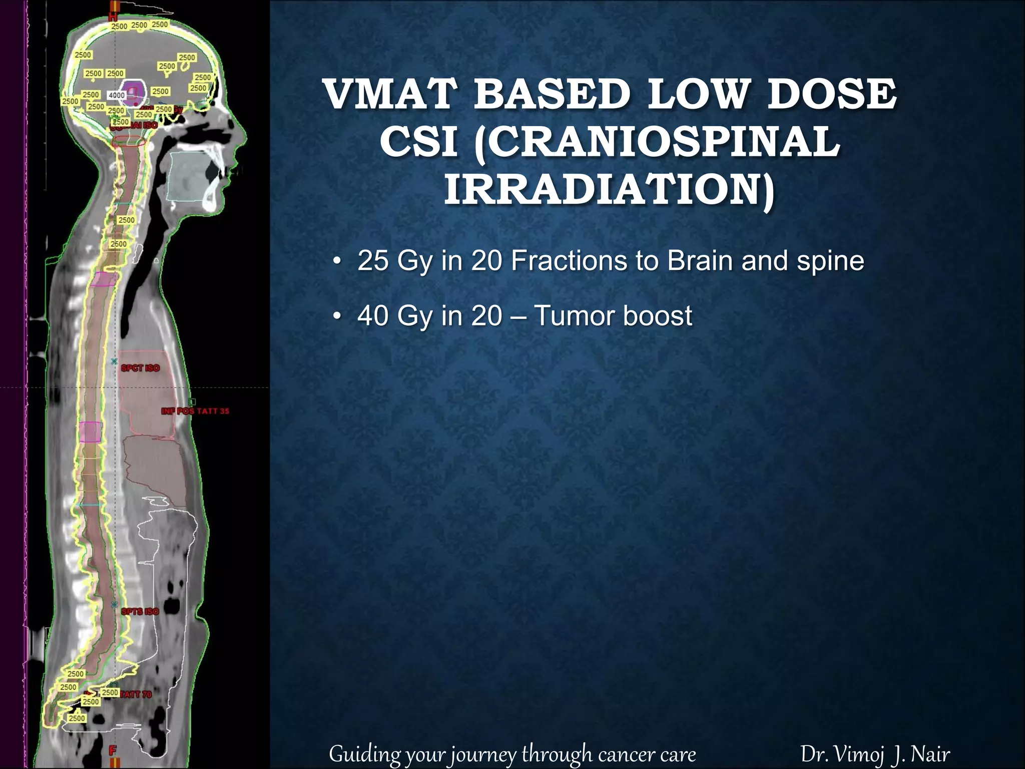 LOW DOSE CRANIOSPINAL IRRADIATION (CSI) USING VMAT , RADIATION FOR ...