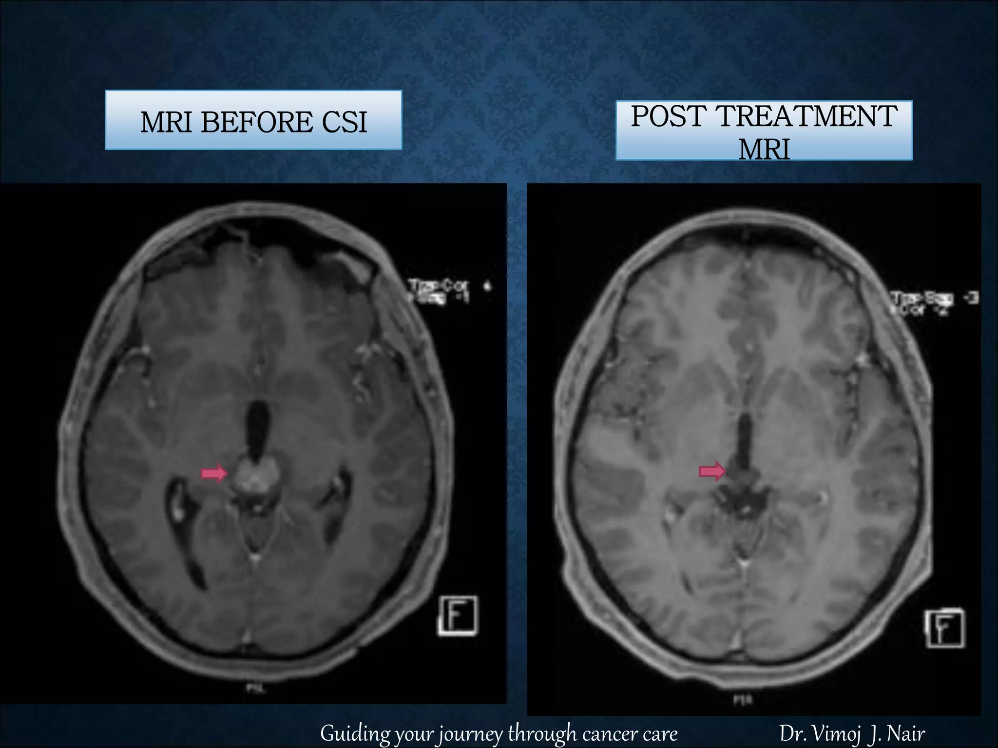 LOW DOSE CRANIOSPINAL IRRADIATION (CSI) USING VMAT , RADIATION FOR ...
