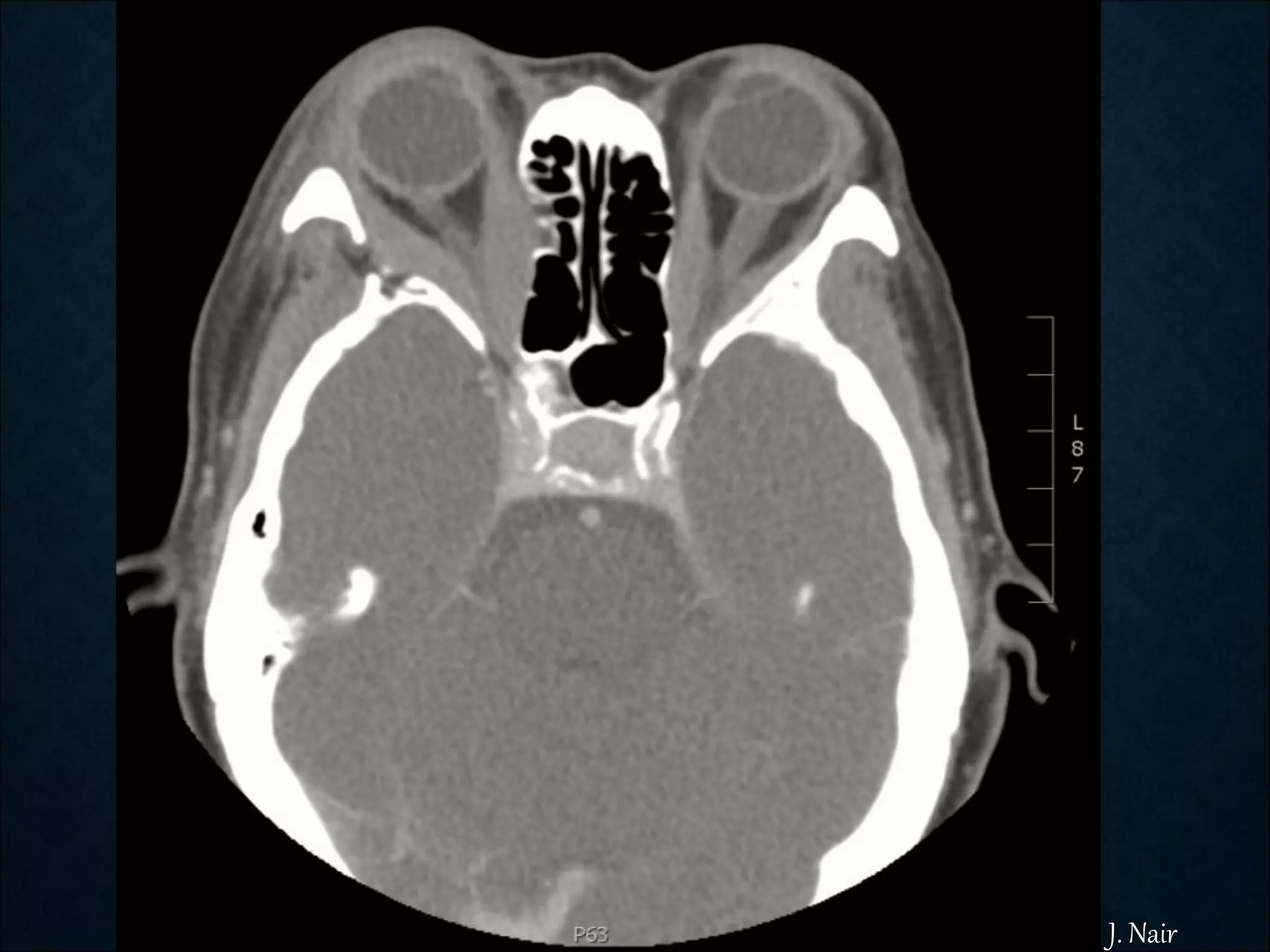 LOW DOSE CRANIOSPINAL IRRADIATION (CSI) USING VMAT , RADIATION FOR ...