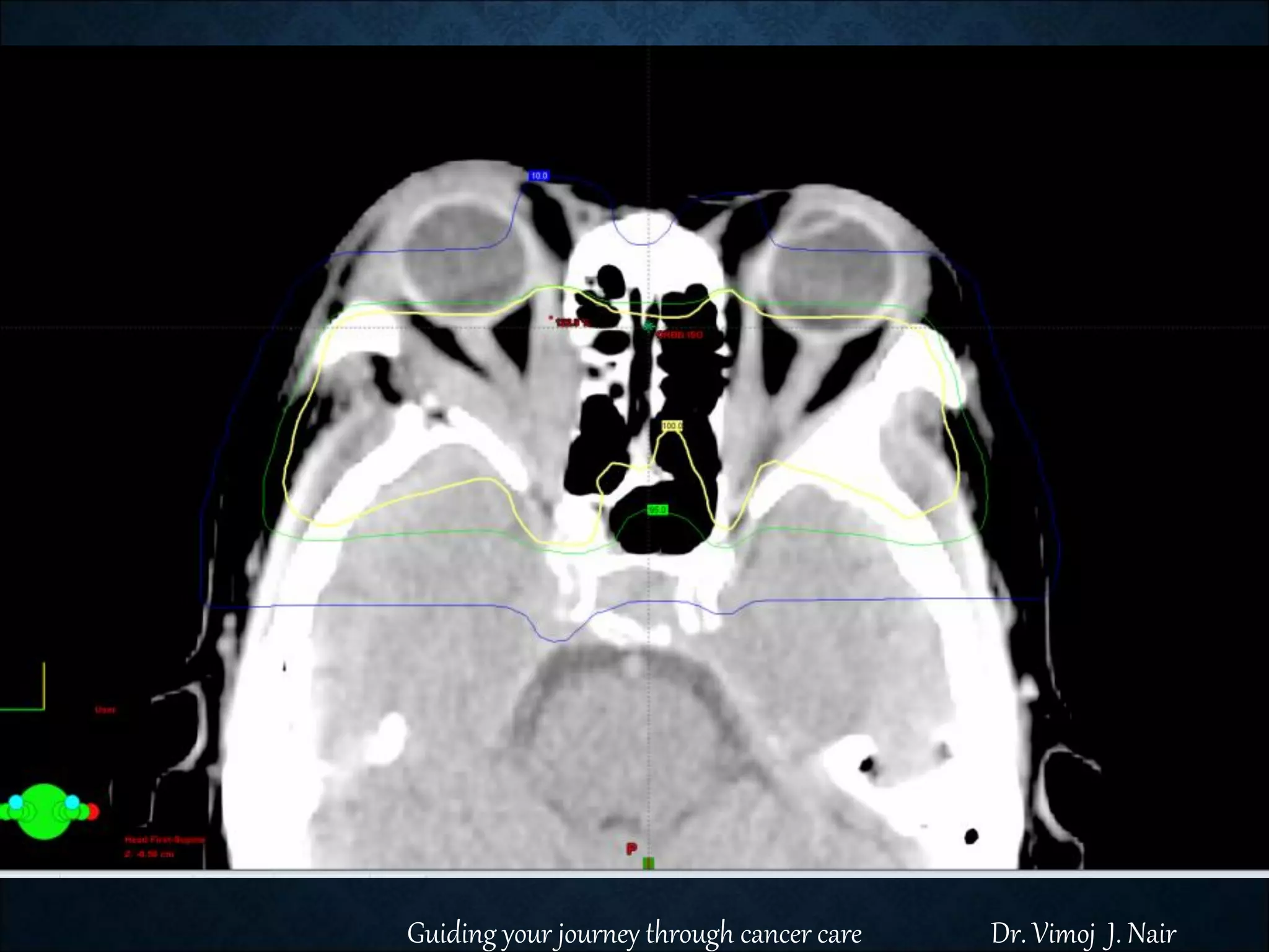 LOW DOSE CRANIOSPINAL IRRADIATION (CSI) USING VMAT , RADIATION FOR ...
