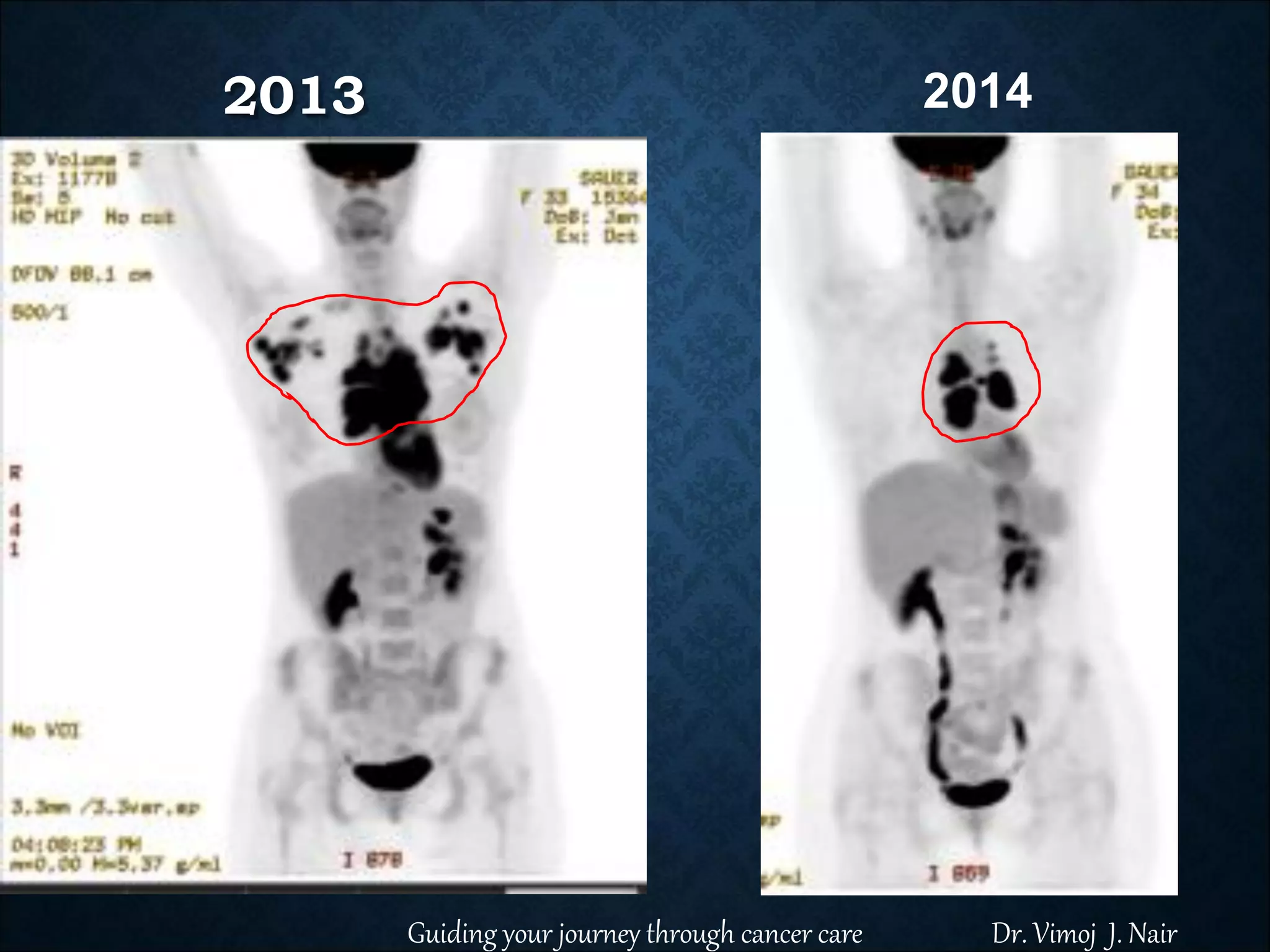 LOW DOSE CRANIOSPINAL IRRADIATION (CSI) USING VMAT , RADIATION FOR ...