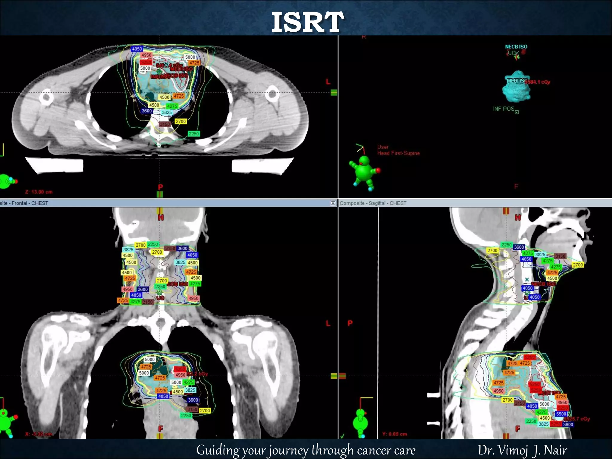 LOW DOSE CRANIOSPINAL IRRADIATION (CSI) USING VMAT , RADIATION FOR ...