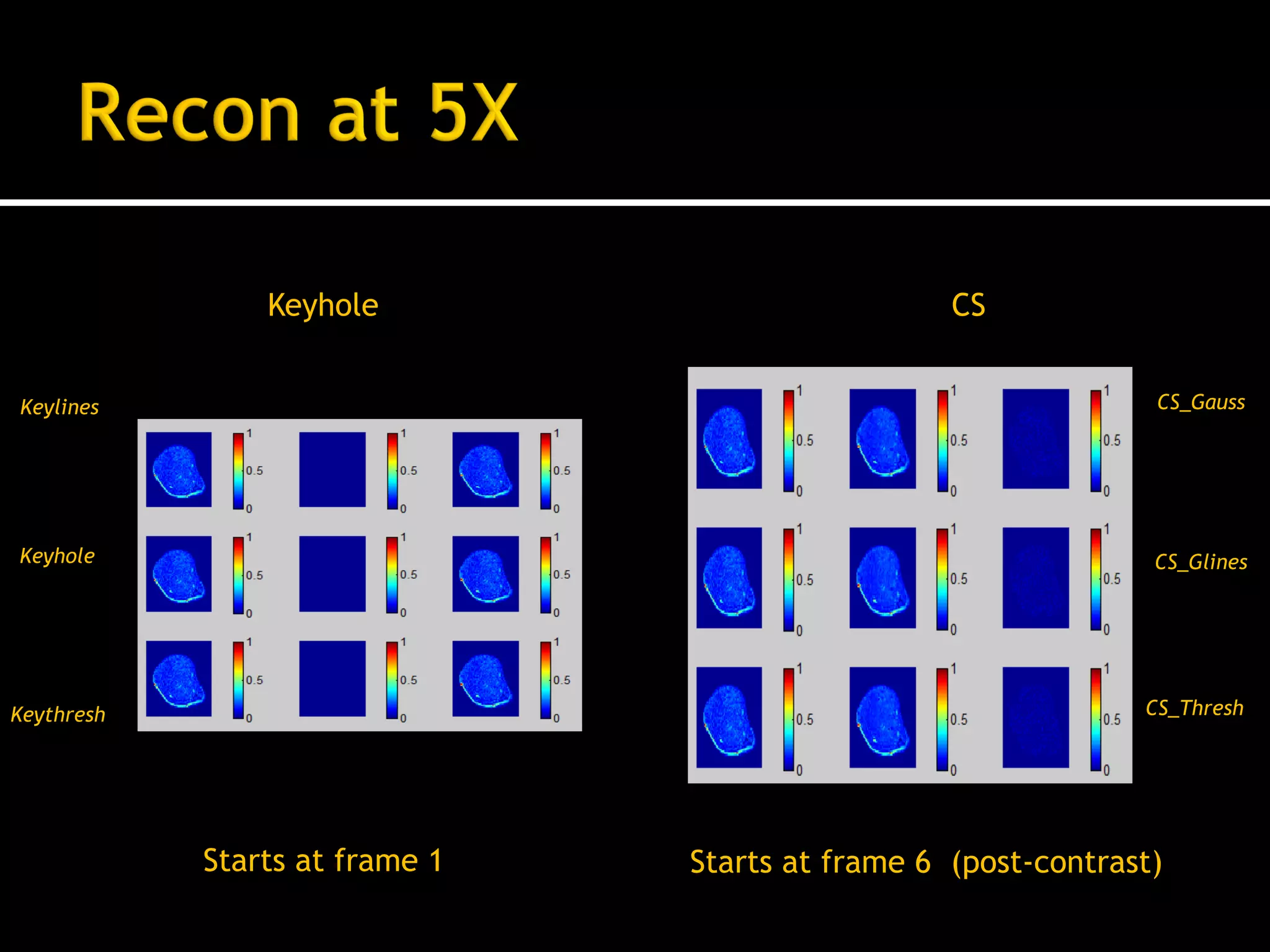 Introduction to compressed sensing MRI | PDF
