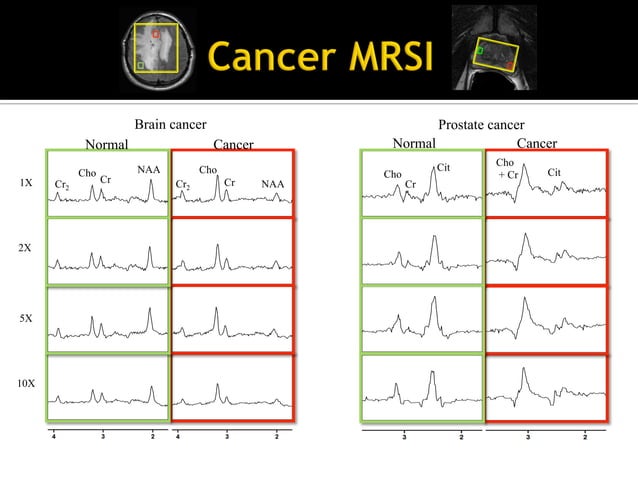 Introduction to compressed sensing MRI | PDF
