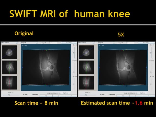 Introduction to compressed sensing MRI | PDF
