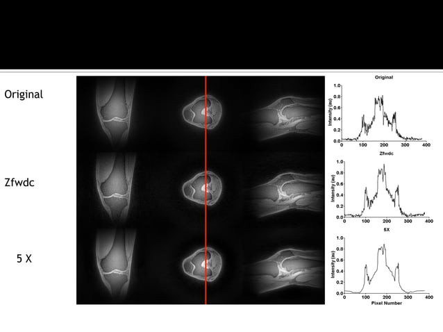 Introduction to compressed sensing MRI | PDF