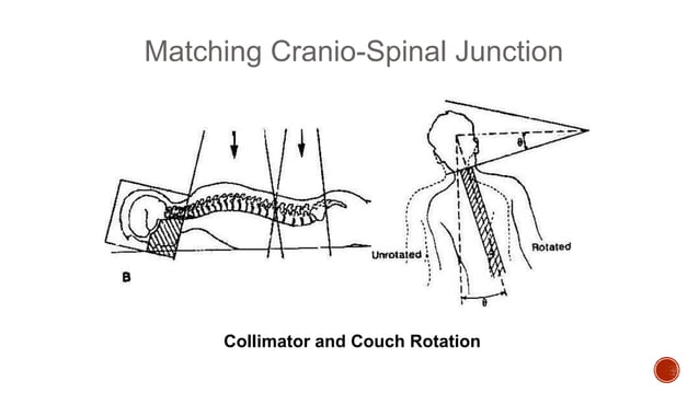 CRANIOSPINAL IRRADIATION-PART 1 | PPTX