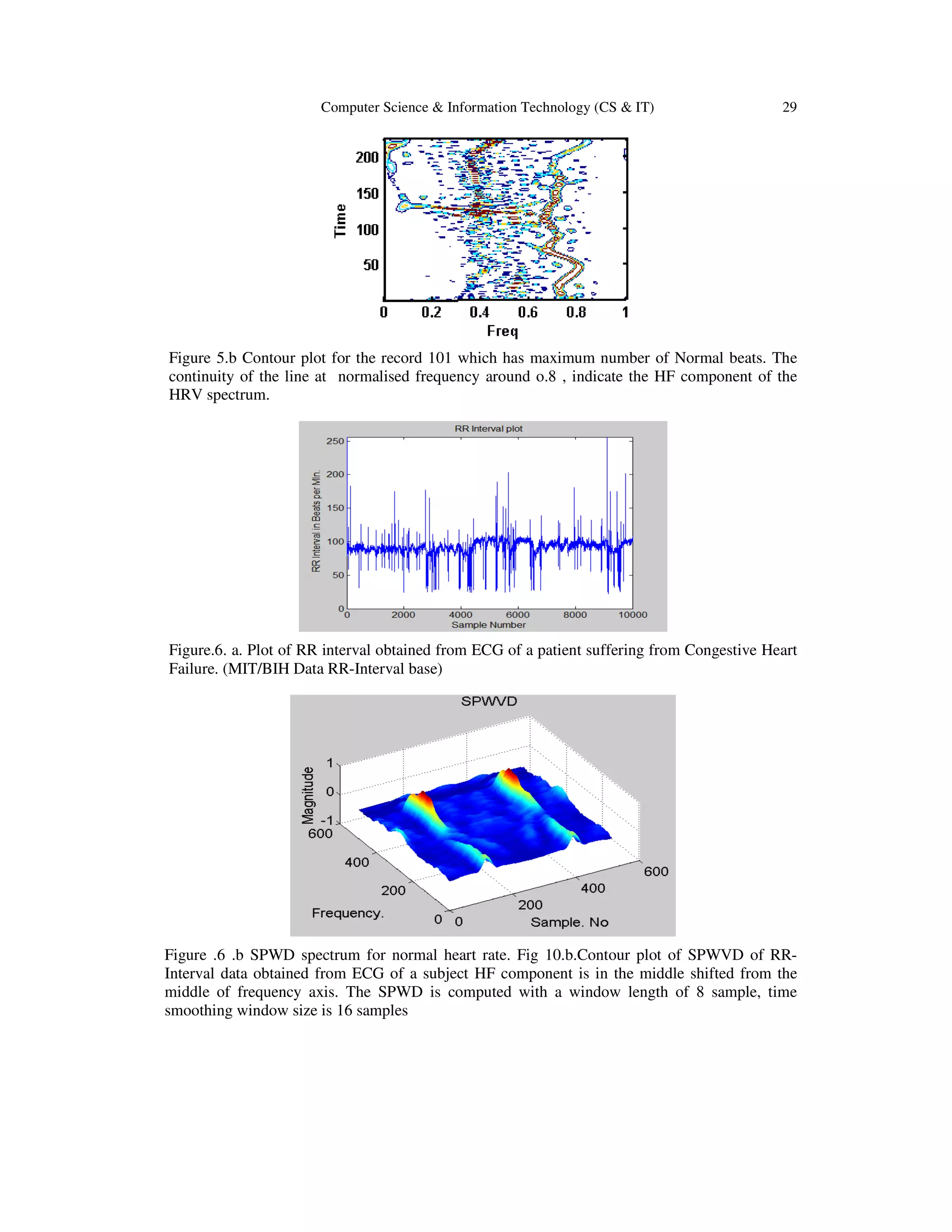 HEART RATE VARIABILITY ANALYSIS FOR ABNORMALITY DETECTION USING TIME FREQUENCY DISTRIBUTION ...
