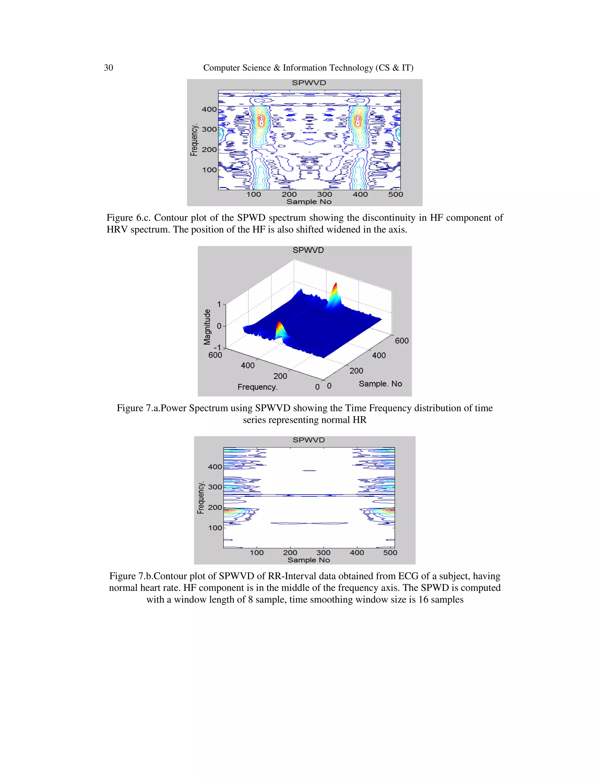 HEART RATE VARIABILITY ANALYSIS FOR ABNORMALITY DETECTION USING TIME FREQUENCY DISTRIBUTION ...