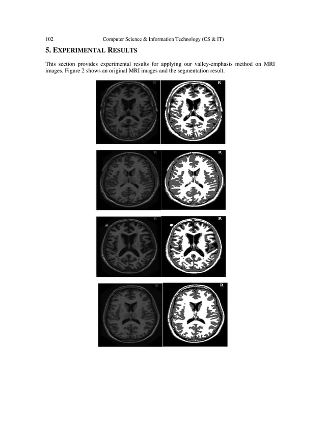MRI IMAGES THRESHOLDING FOR ALZHEIMER DETECTION | PDF | Photo Editing Software | Computer ...
