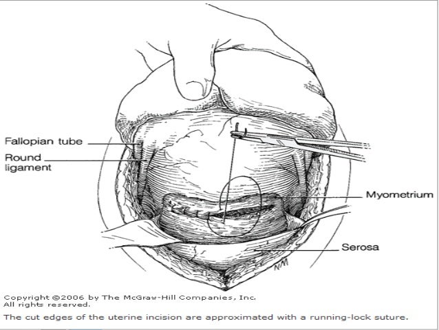 Cesarean Section Cs