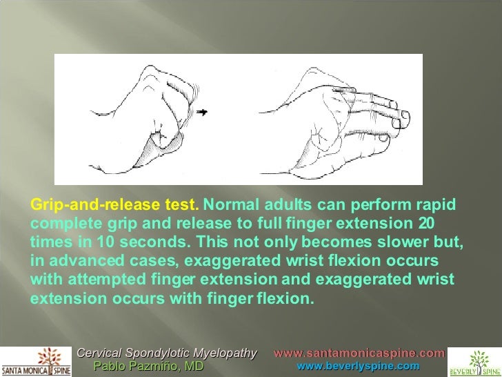 Cervical Arthritis / Cervical Spondylotic Myelopathy / Cervical Steno…