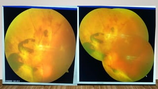 Csme pdr +retinitis proliferans | PPTX | Eye and Vision Conditions ...