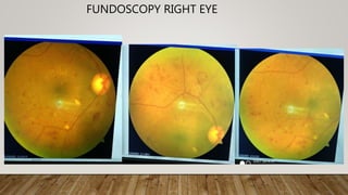 Csme pdr +retinitis proliferans | PPTX | Eye and Vision Conditions ...
