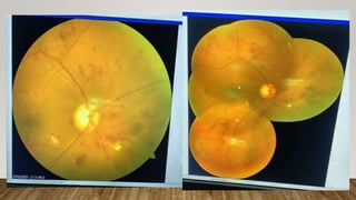 Csme pdr +retinitis proliferans | PPTX | Eye and Vision Conditions ...