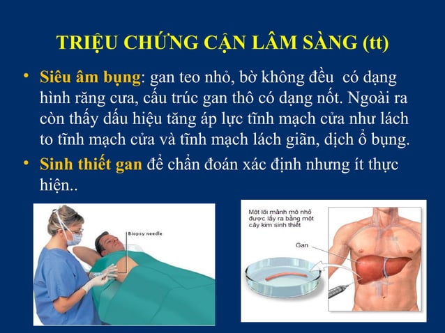 Csnb xơ gan | PPT