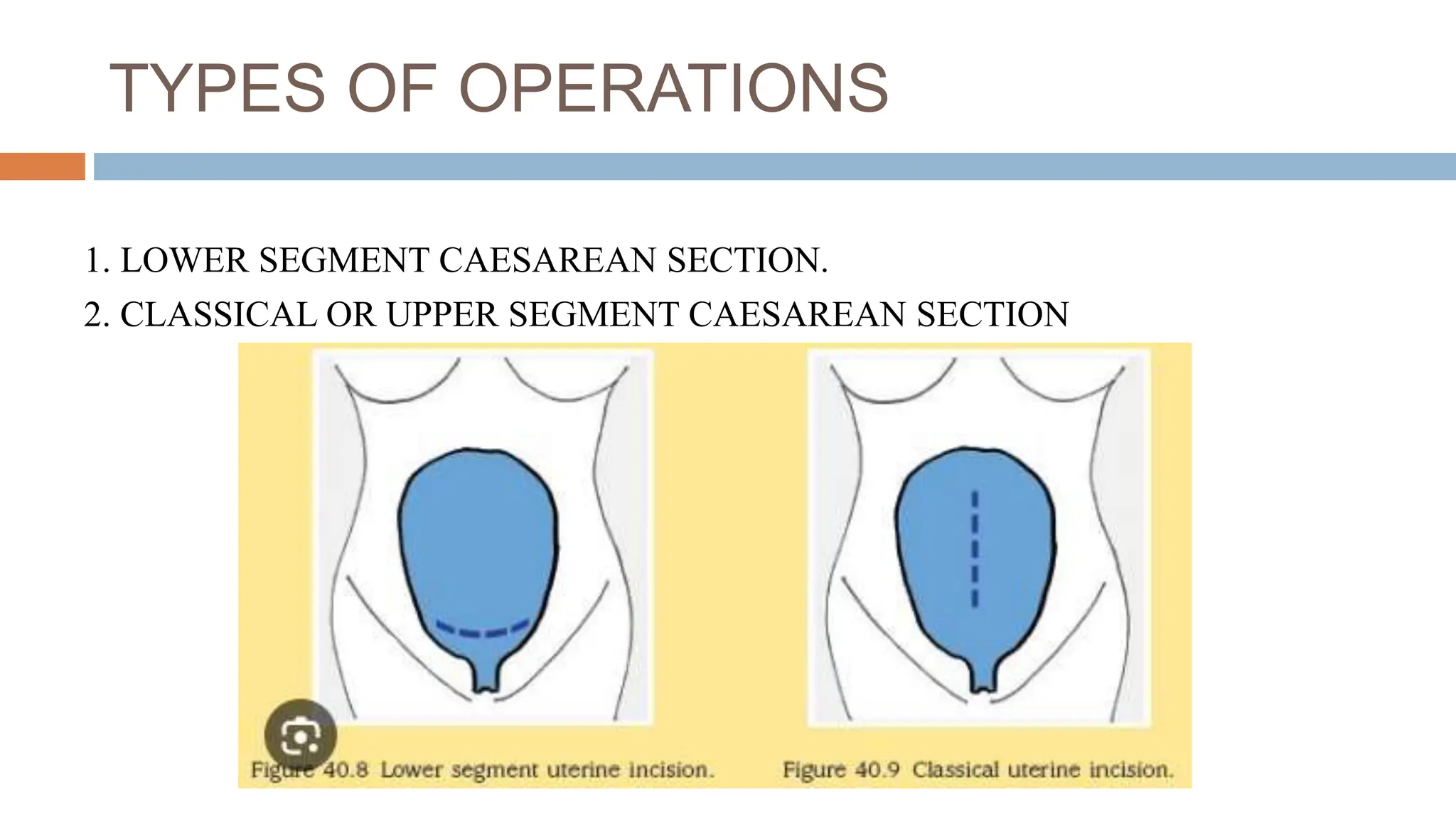 Lower segment cesarean section powe point presention | PPTX