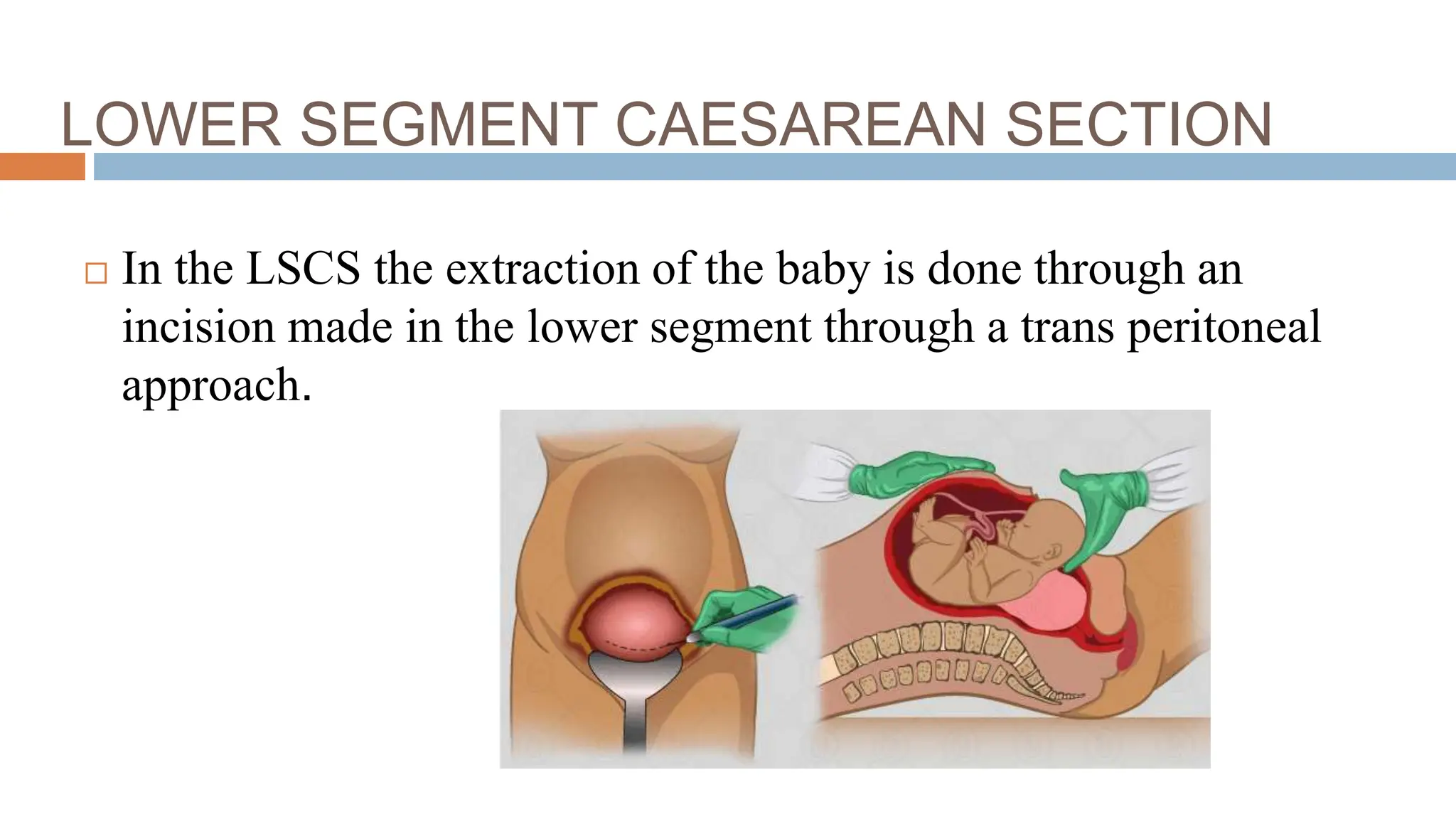 Lower segment cesarean section powe point presention | PPTX