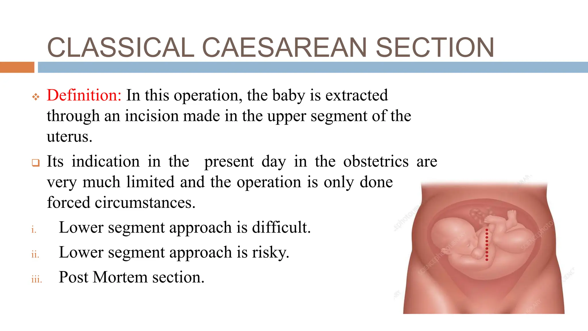 Lower segment cesarean section powe point presention | PPTX