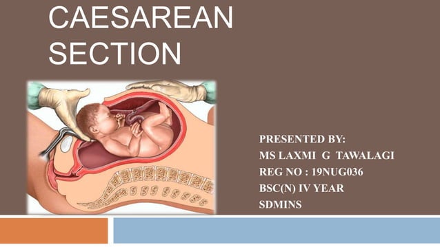 Lower segment cesarean section powe point presention | PPTX