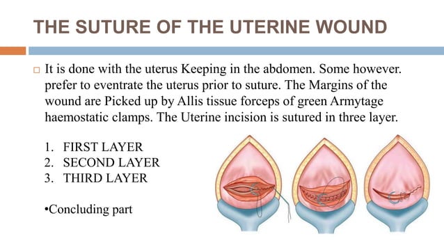 Lower segment cesarean section powe point presention | PPTX