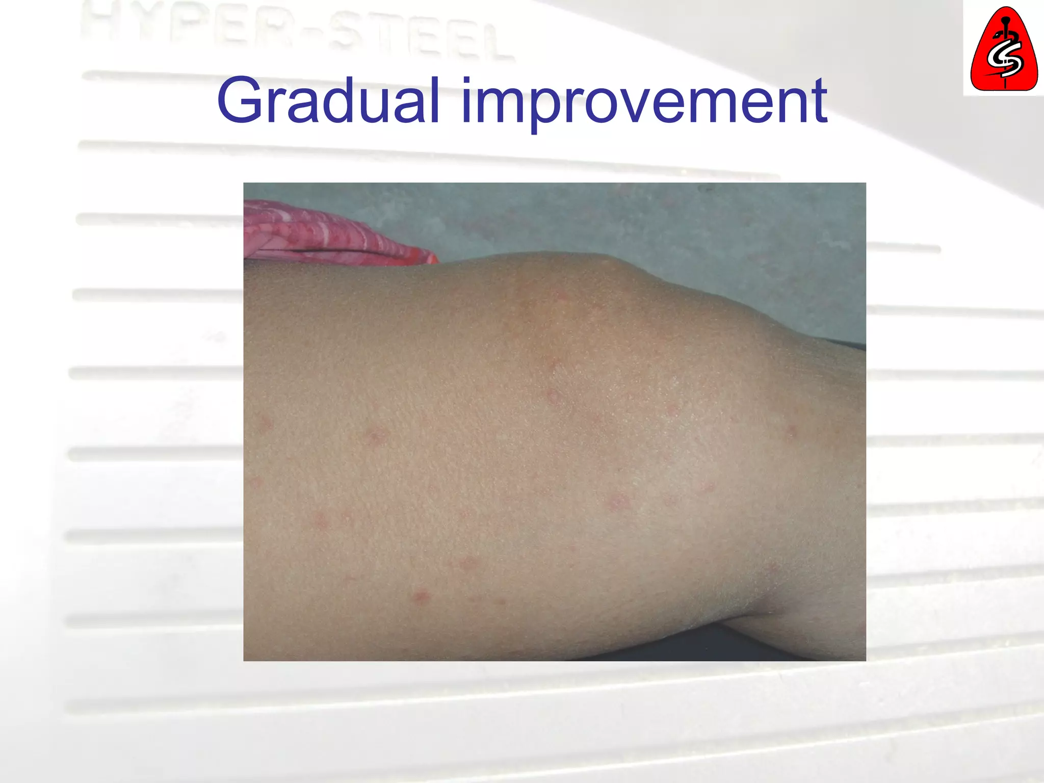 Sweet syndrome to ? | PPT