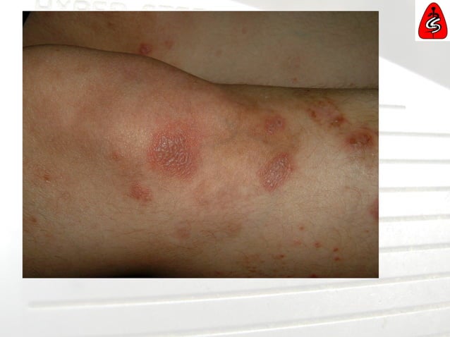 Sweet syndrome to ? | PPT