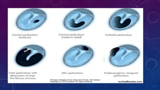 CSOM atticoantral.pptx