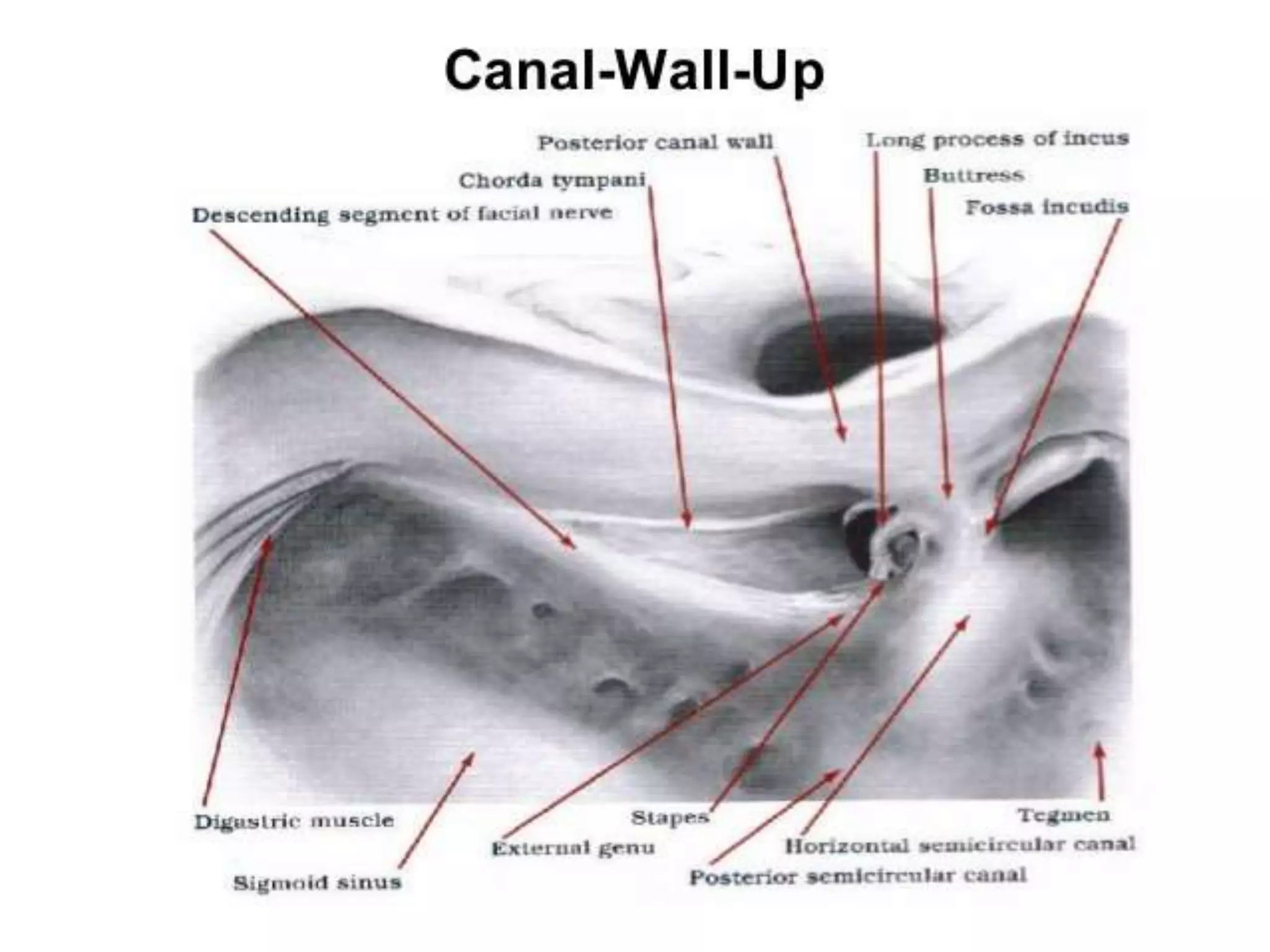 Csom, cholesteatoma | PPTX