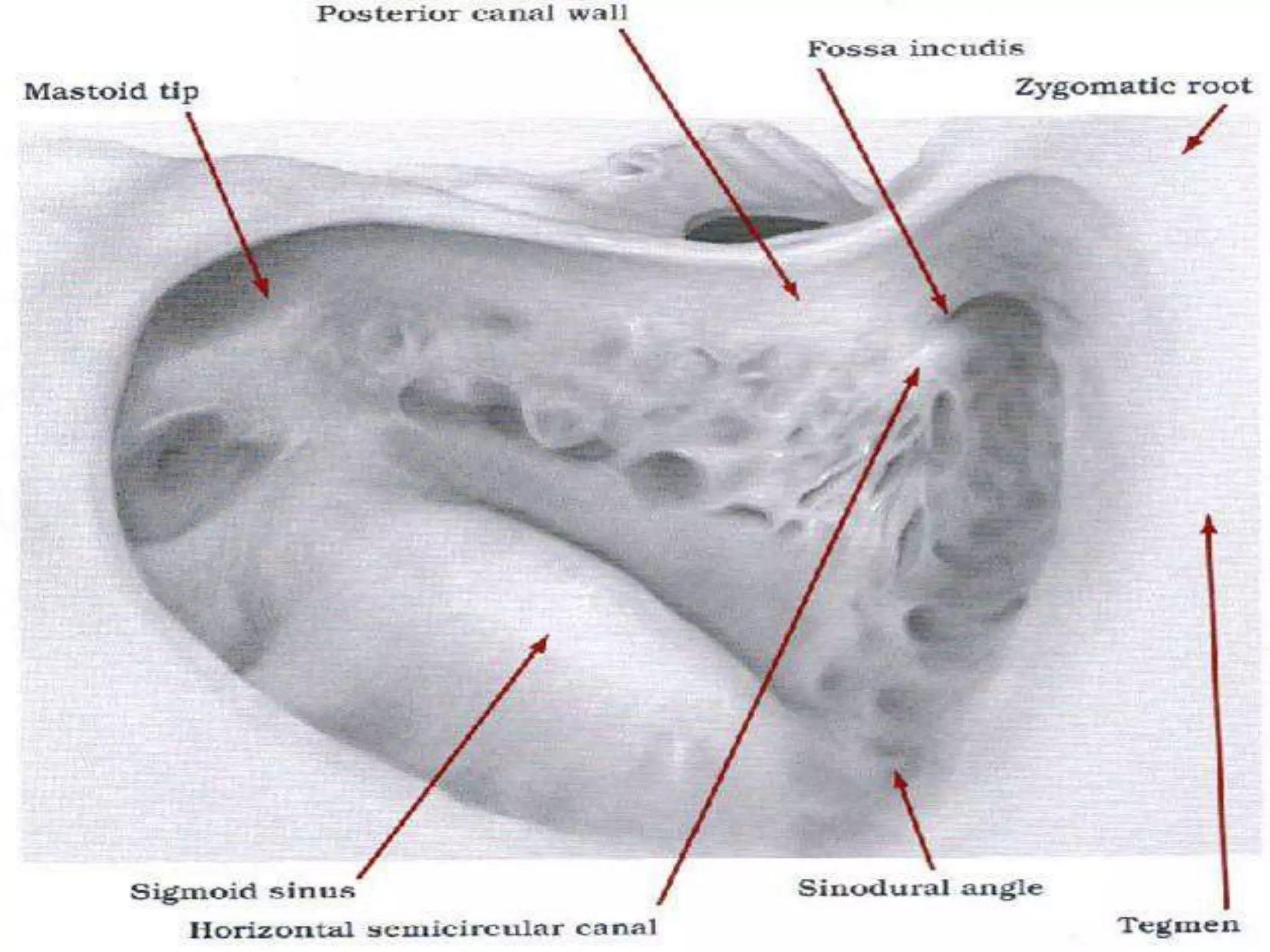 Csom, cholesteatoma | PPTX | Ear, Nose and Throat Conditions | Diseases ...