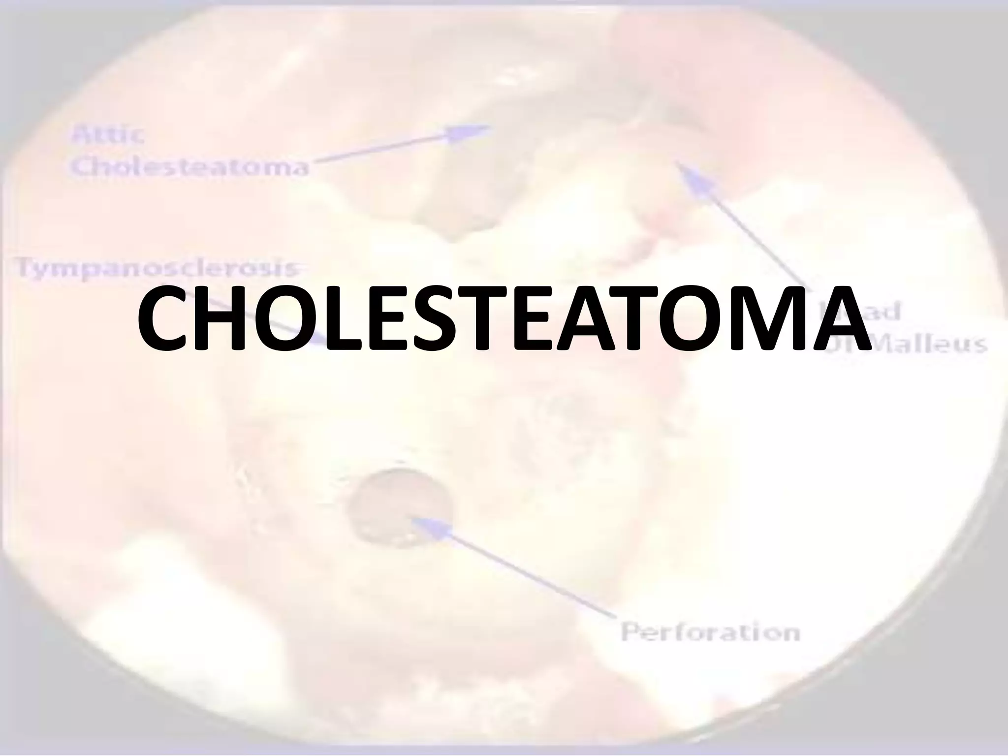 Csom, cholesteatoma | PPTX